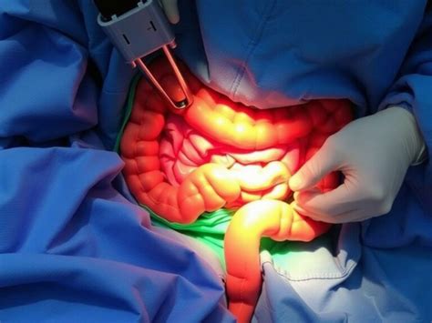 Open Appendectomy Procedure Benefits And Recovery Guide