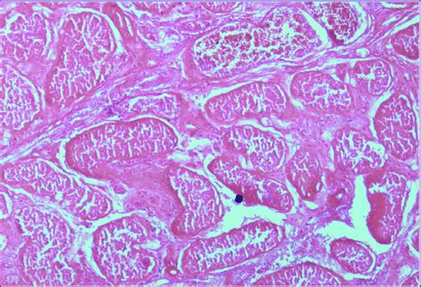 Necrosis Of The Testicular Parenchyma Associated With Cavernous
