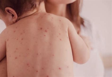 Дорнод 📌Дорнод аймагт Улаан бурхан өвчний батлагдсан тохиолдол бүртгэгдлээ Халдвар авсан