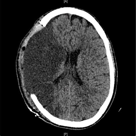 Three Dimensional Rendering Of The Right Decompressive Hemicraniectomy Download Scientific Diagram