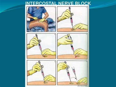 Regional Anesthesia Ppt Download