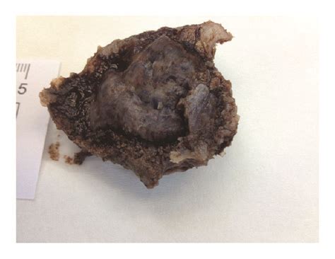 Angiosarcoma Of The Scalp A Gross Appearance Of The Resected Specimen