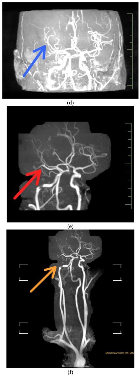 Encephalomalacia In A Young Adult A Rare Presentation V1