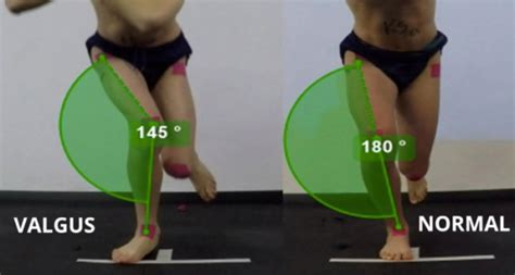 3 Two Minute Knee Valgus Exercises To Fix The Root Cause Precision Movement