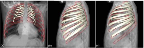 Towards Model Based 3 D Reconstruction Of The Human Rib Cage From