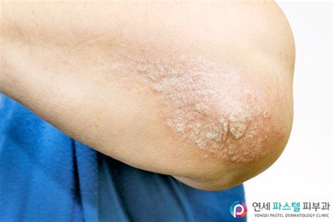 얼굴건선 피부건선 증상 원인과 치료법 네이버 블로그