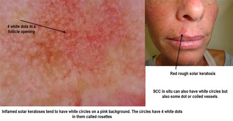 Dermatoscopy Made Simple Solar Keratosis