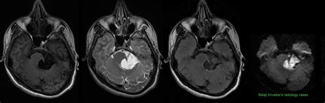 Dr Balaji Anvekar Frcr Epidermoid Cyst Mri