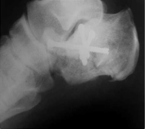 Postoperative Lateral View X Ray Of The Subtalar Joint Download Scientific Diagram