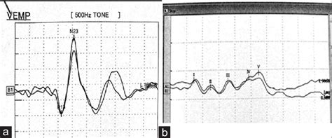 A Normal Cvemp Waveforms B Normal Baep Waveforms Download Scientific Diagram