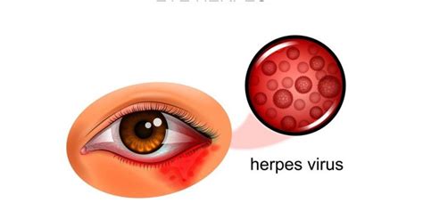 Blepharitis Symptoms And Causes News185