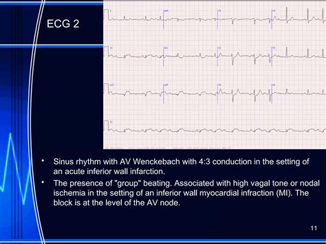 ECG Approach To Arrhythmias 2017 PPT Heart And Cardiovascular Diseases Diseases And Conditions