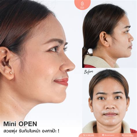 เปลี่ยน เป๊ะ ปัง😲 เทคนิคที่3 Miniopen รองปลาย กระดูกอ่อนหลังหู หลังทำ 1 เดือน กับทรง