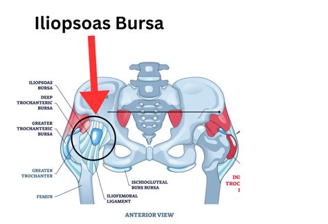 Iliopsoas Tendinopathy Treatment Iliopsoas Bursitis