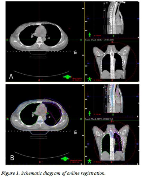 Evaluation Of Positional Error During Radiotherapy For Breast Cancer