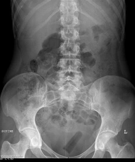 Foreign Body Wikidoc