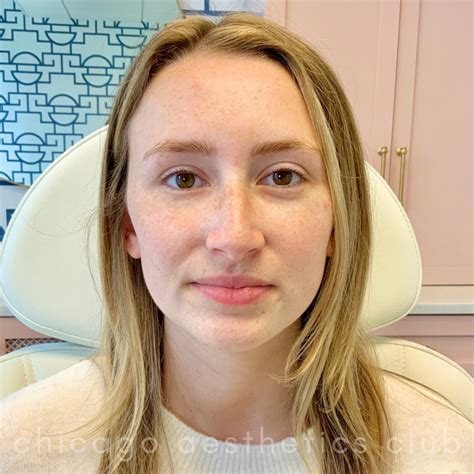 Preventative Botox Gallery Chicago Aesthetics Club