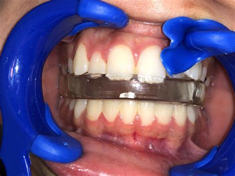 Bite Plate Before And After At Ronald Whitehurst Blog