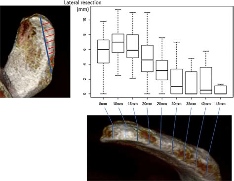 Average Width Of Acromial Resection From Front Left Of Lower Image To