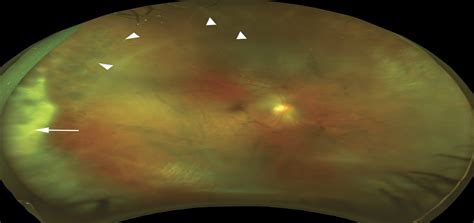 Recurrent Acute Retinal Necrosis Retinal Cases And Brief Reports