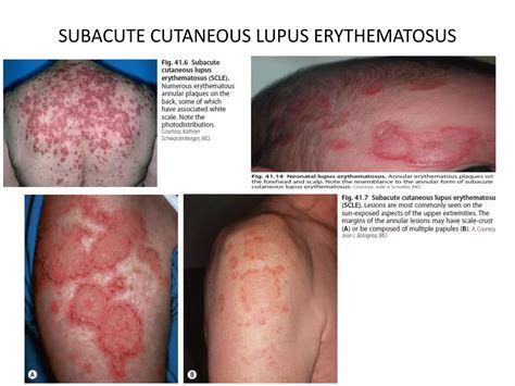 Lupus Erythematosus For Dermatologists Pptx