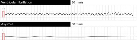 Ventricular Fibrillation Pulseless Electrical Activity And Sudden Cardiac Arrest ECG Learning