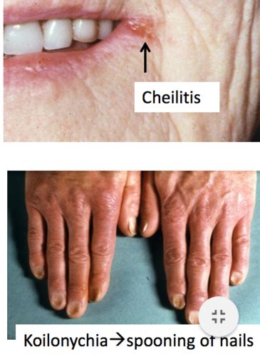 PA Microcytic Anemias Flashcards Quizlet