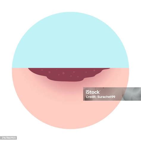 Mpox 원숭이 수두 질병 5기 Mpox 피부 증상의 딱지 황반 증상 개념에 대한 스톡 벡터 아트 및 기타 이미지 개념 건강 검진 건강 진단 Istock