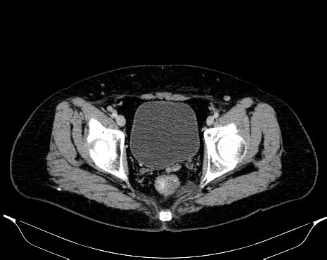 Radiopaedia Case Sex Reassignment Surgery Id Study NC Commons