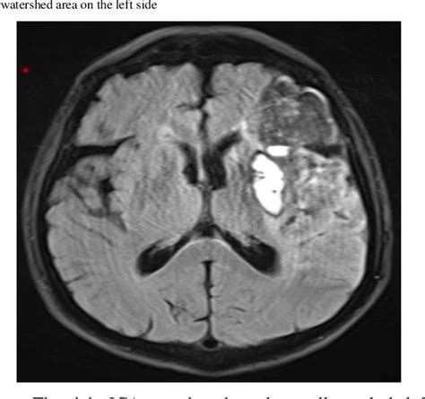 Figure 1 From Internal Carotid Artery Agenesis And Contralateral Middle Cerebral Artery