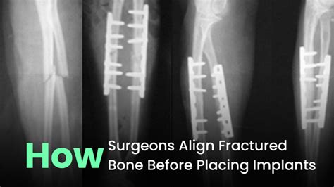 Top Orthopedic Manufacturers In India Ortho Care