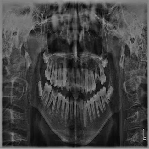 Dental Disease Classificaton123 Object Detection Dataset V1 2023 05