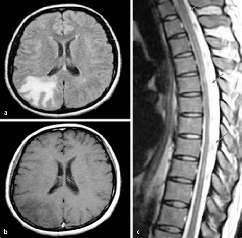 Brain And Spinal Cord Mri In Case 1 A B A Large Tumefactive Lesion Download Scientific