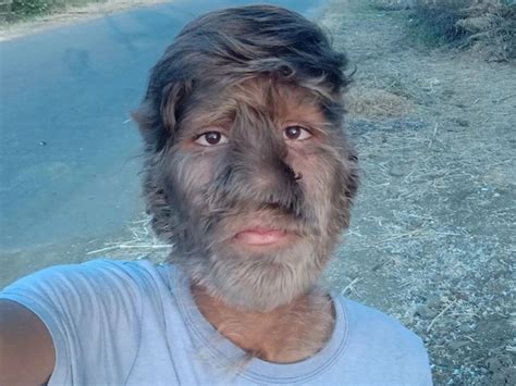 क्या है Werewolf Syndrome जिससे भालू जैसा बन जाता है इंसानी चेहरा