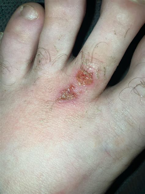 Got A Burn A Couple Of Days Ago And The Blister Popped Just Wanted To