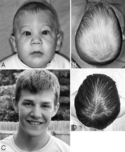 Endoscopy Assisted Early Correction Of Single Suture Metopic