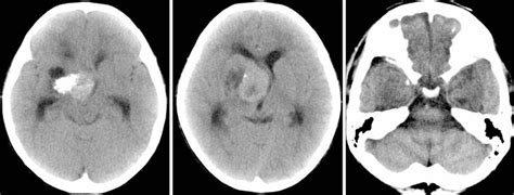 Ct Revealing Calcification Necrosis Cystic Formation Of The Mass