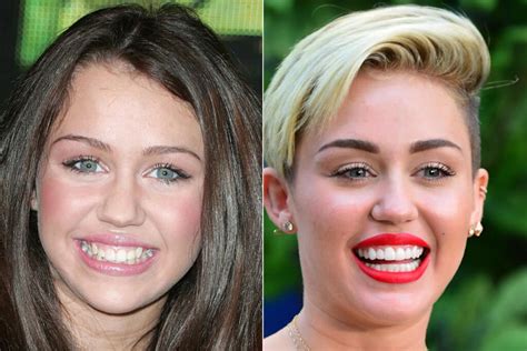 Miley Cyrus Dental Veneers Transformation Destination Smile