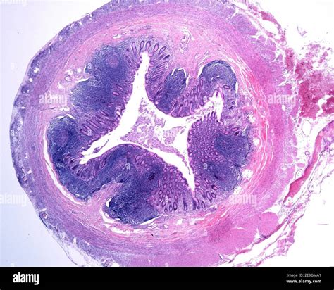 Cross Section Of A Human Vermiform Appendix The Wall Is Thickened Due To The Presence Of