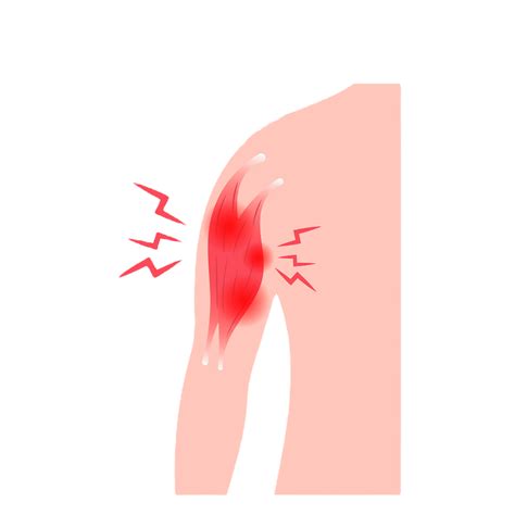 Trigger Point Dry Needling