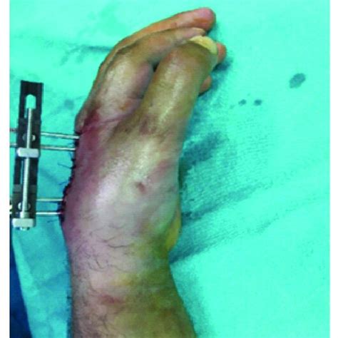 Anterior View Of The Left Hand Metacarpal External Fixator Download Scientific Diagram