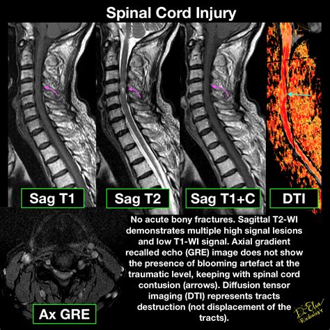 Mri Spine Anatomy Free Mri Lumbar Spine Sagittal Cross Sectional Anatomy Artofit