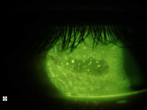 Sonoran Desert Eye Center Bitots Spot