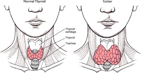 Goiter All About Goiter