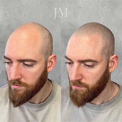 Should I Get Scalp Micropigmentation Is Smp Worth It
