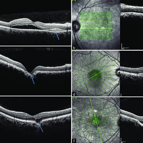 Spectral Domain Optical Coherence Tomography Showing A Focal Choroidal Download Scientific