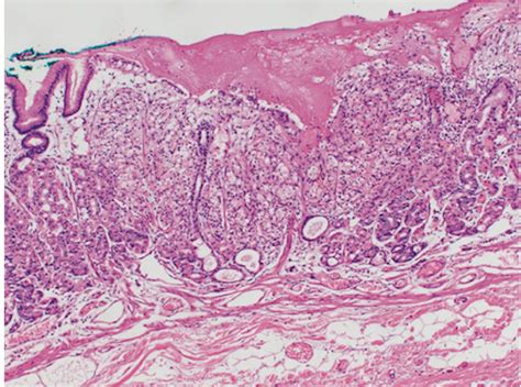 The Resected Specimen Was Approximately 3 Mm In Diameter With A Clear