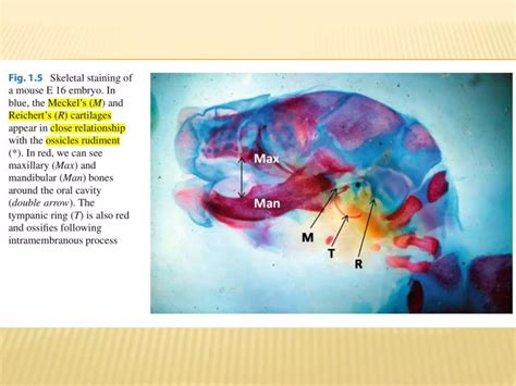 Temporal Bone Mastoid Anatomy Arjun Antony Graison PPTX