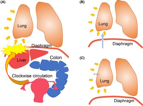 Hypothesized Pathogenesis Of Catamenial Pneumothorax Cp And Download Scientific Diagram