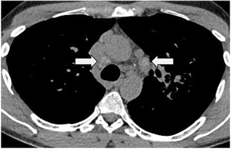 Imaging Of Pulmonary Sarcoidosis—a Review